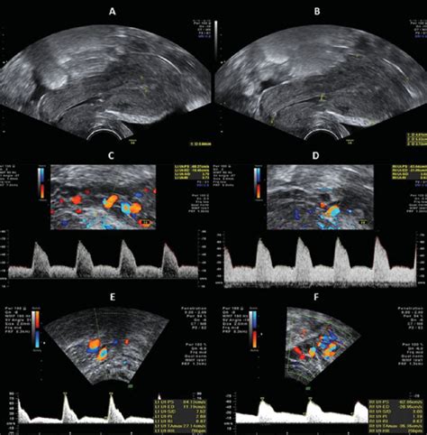 Transvaginal Sonography And Uterine Arterial Uta Waveforms At 7 Weeks