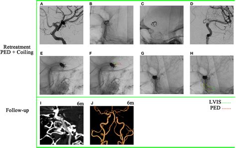 Frontiers Retreatment With A Pipeline Embolization Device For