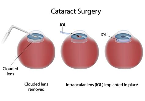 Cataract Surgery And Glaucoma Glaucoma Associates Of Texas
