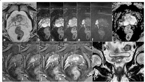 Prostate Multiparametric Magnetic Resonance Imaging Showing A