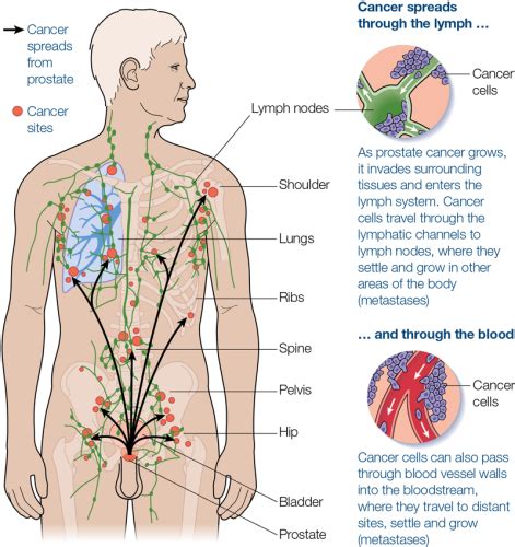 What Is Metastatic Prostate Cancer The Waiting Room
