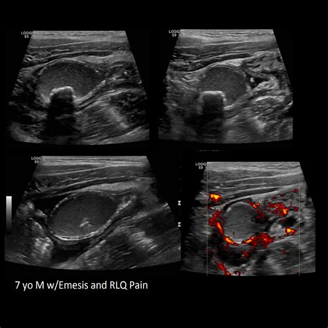 Appendix Gallery Sonographic Tendencies
