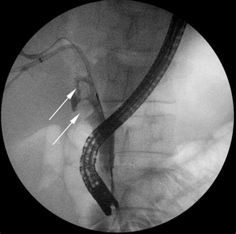 percutaneous transhepatic cholangioscopy and stone extraction in a