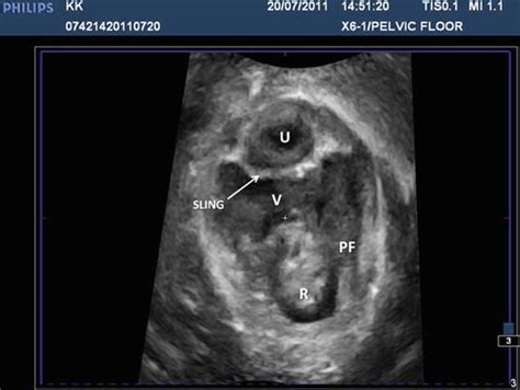 Principles And Applications Of 3d Pelvic Floor Ultrasound Pelvic