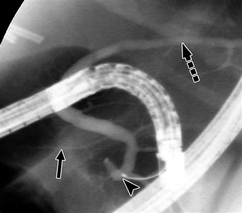 Annular Pancreas In Adults Ajr