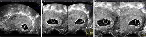 8w2d Ultrasound Shows Only Yolk Sac Definite Miscarriage Mumsnet