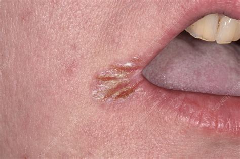 Angular Cheilitis Stock Image C047 2876 Science Photo Library