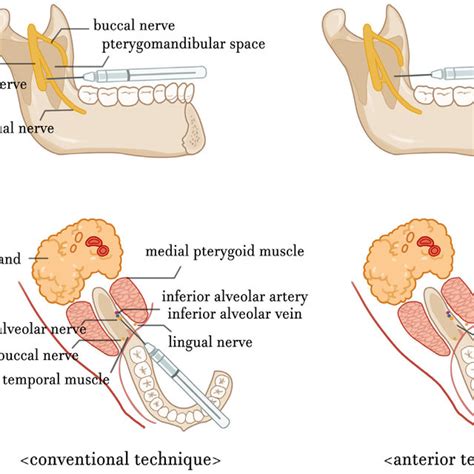 Inferior Alveolar Nerve Block Landmarks