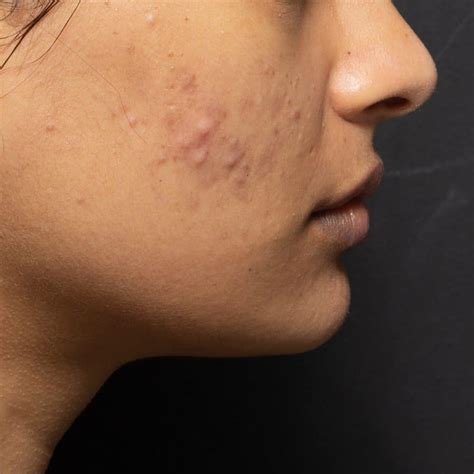 Acne Treatment Treat Acne Professionally Rejuvenation Clinics Of