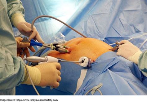 Laparoscopy For Infertility Treatment Success Rate Saraogi Hospital