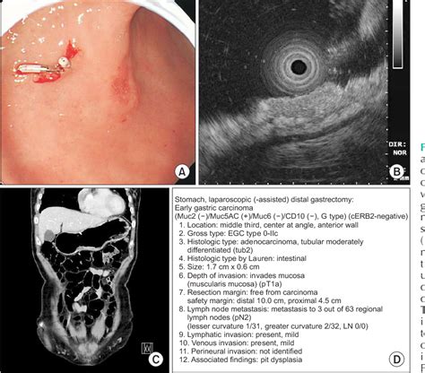 Figure 1 From Risk Factors For Lymph Node Metastasis In Mucosal Gastric