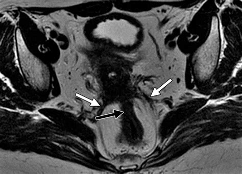 Uterosacral Ligaments On Transvaginal Ultrasound A Vi