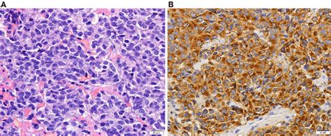 Histology Of A Prolactin Producing Pituitary Tumor Tumor With