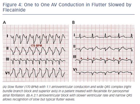 Atrial Fibrillation Vs Atrial Flutter Ecg