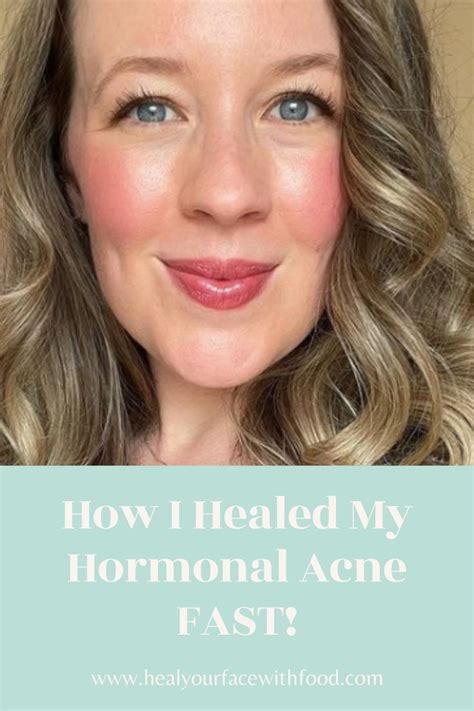 Hormonal Acne Supplements Artofit