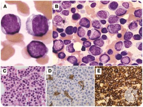 plasma cell neoplasm with plasmablastic morphology mimicking acute leukemia