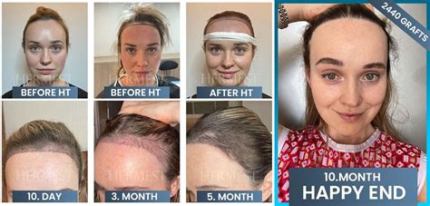 The Top 10 Best Hair Transplant In Turkey Hermest Clinic