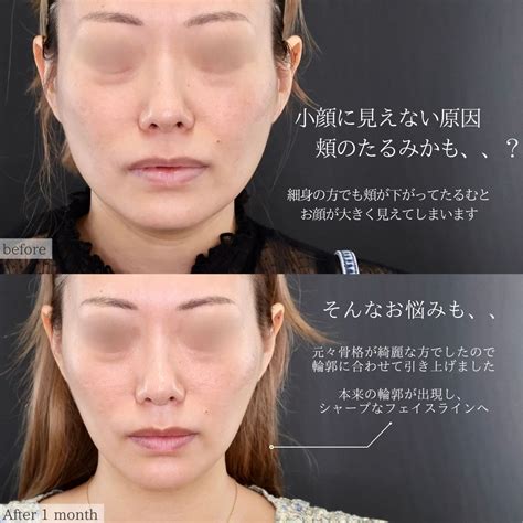 【糸リフト×エラボトックス】輪郭vラインですっきり小顔に！｜症例写真・ビフォーアフター｜美容整形･美容外科のtaクリニックグループ