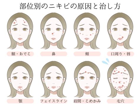 ニキビの原因とは？ニキビの治し方を種類や部位別に解説 フォーシーズンズ美容皮膚科クリニック美容コラム