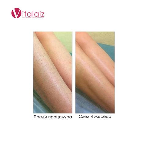 Галерия Лазерна епилация Vitalaiz Център