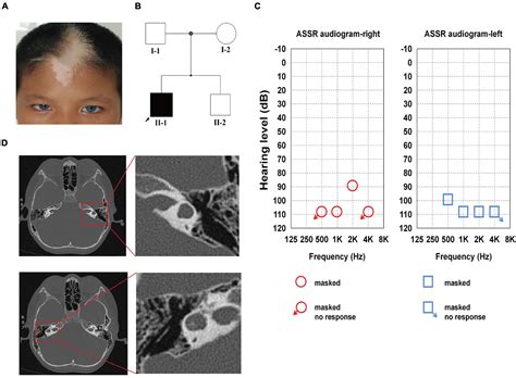 Frontiers A Model Of Waardenburg Syndrome Using Patient Derived Ipscs