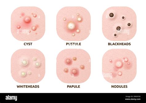 Body Skin Acne Type Blackheads Whiteheads Papule Pustule Cyst And