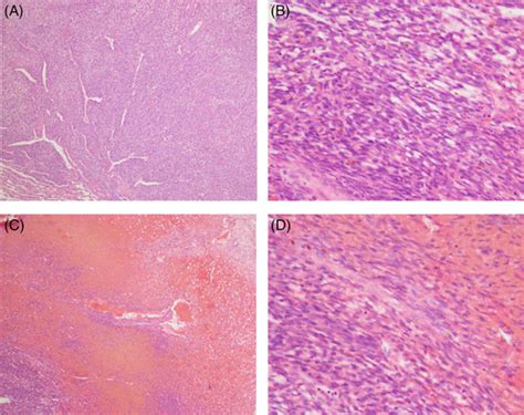 Primary Pleural Synovial Sarcoma With Repeated Resection Leading To