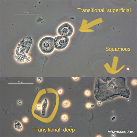 Urine Sediment Of The Month 4 Flavors Of Nucleated Cells Renal