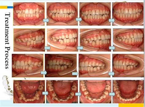 Lingual Braces Before And After
