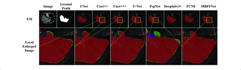 Segmentation Effect Of Liver Lesions Download Scientific Diagram