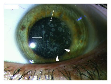 Slit Lamp Examination Shows Multiple Bilateral A Right Eye B Left