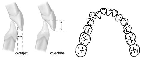 Overjet Vs Overbite