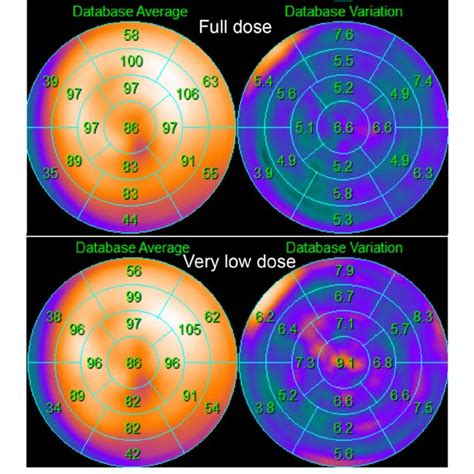 The Pattern Of Abnormal Myocardial Perfusion Scan Findings Download Table
