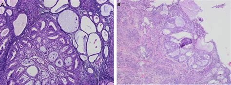 Histopathological Appearances Of Endometrioid Adenocarcinoma He × 10