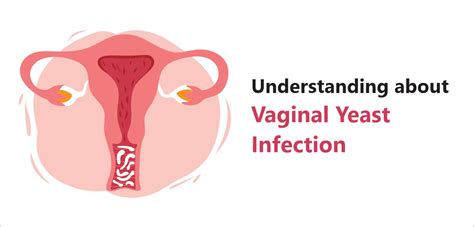 Understanding About Vaginal Yeast Infection Nh Assurance