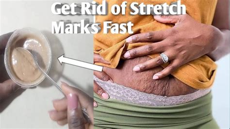 How To Remove Stretch Marks Permanently World Best Remedy To Get Rid