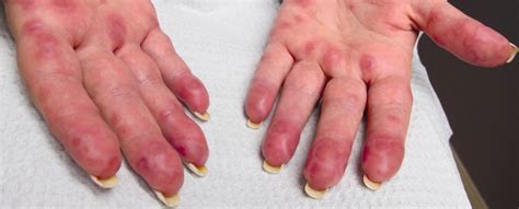 Targetoid Palmoplantar Sweet Syndrome As Presenting Sign Of Severe