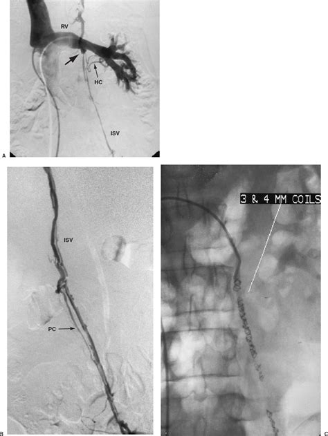 Varicocele And Female Infertility Radiology Key
