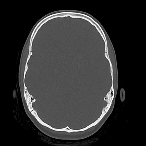 Cerebral Cavernous Venous Malformation Radiopaedia 70008 80022 Axial