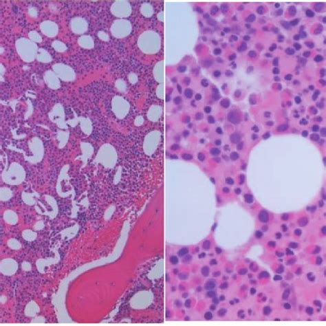 The Bone Marrow Biopsy Shows A Markedly Hypercellular Marrow With