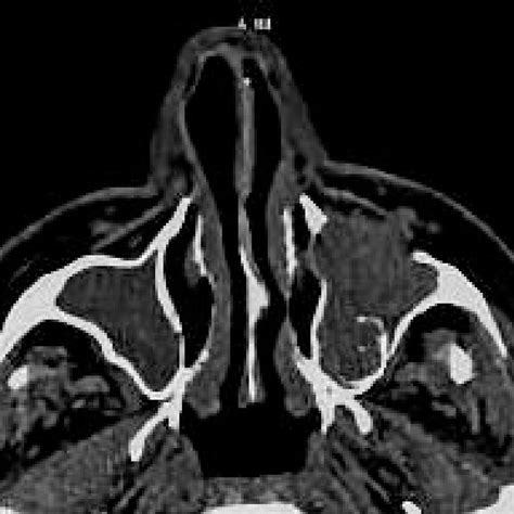 Contrast Enhanced T1 Weighted Axial Mri Image At Diagnosis Showing A