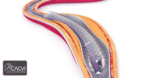 Peripheral Angiogram Plasty Center For Advanced Cardiac And Vascular
