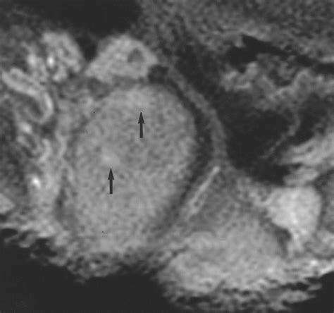 Testicular Leydigs Cell Hyperplasia Mr Imaging And Sonographic