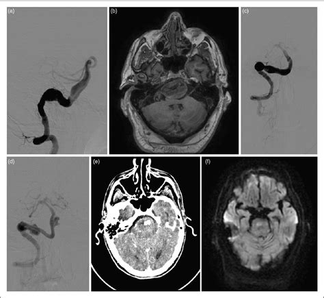 Figure 1 From Treatment Of Vertebrobasilar Fusiform Aneurysms With