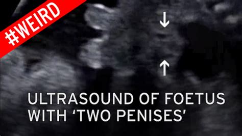 Man With Two Penises Releases Memoir About Living With Extremely Rare