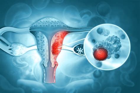 Many Women Dont Know This Warning Sign Of Endometrial Cancer
