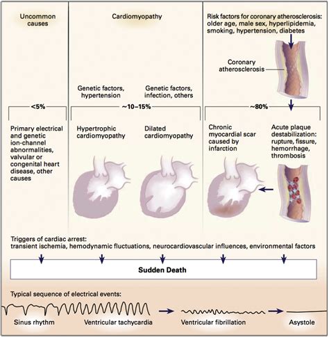 Ventricular Arrhythmias And Sudden Cardiac Death Cardiac