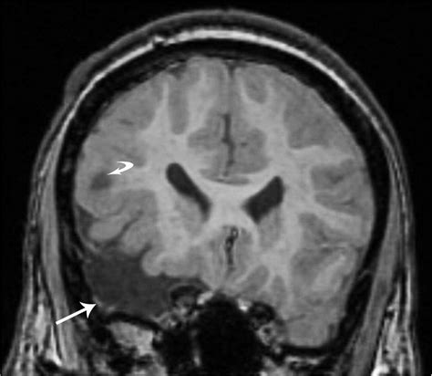 Arachnoid Cysts In Tuberous Sclerosis Complex Brain And Development