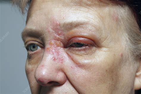 Shingles Rash Eye