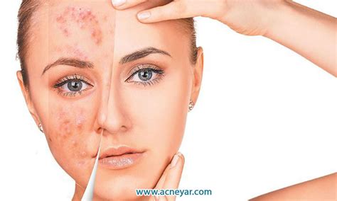 عوامل ایجاد جوش آکنه صورت آکنه یار درمان لک و جوش ویزیت آنلاین